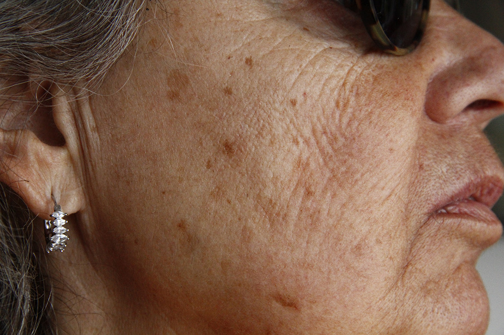 Via le macchie dal viso! - Il Circolo